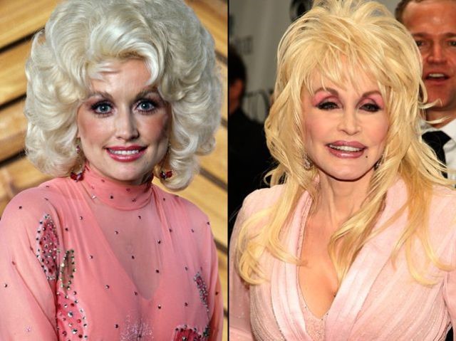6 Facts About Dolly Parton Plastic Surgery